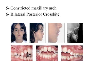 Management of open bite in orthodontics... | PPTX