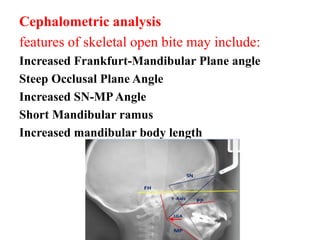 Management of open bite in orthodontics... | PPTX