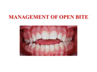 Management of open bite in orthodontics... | PPTX
