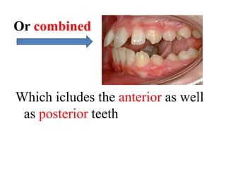 Management of open bite in orthodontics... | PPTX