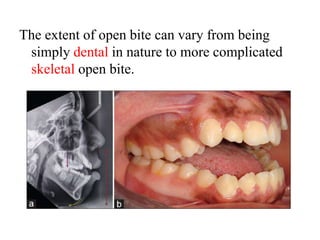 Management of open bite in orthodontics... | PPTX