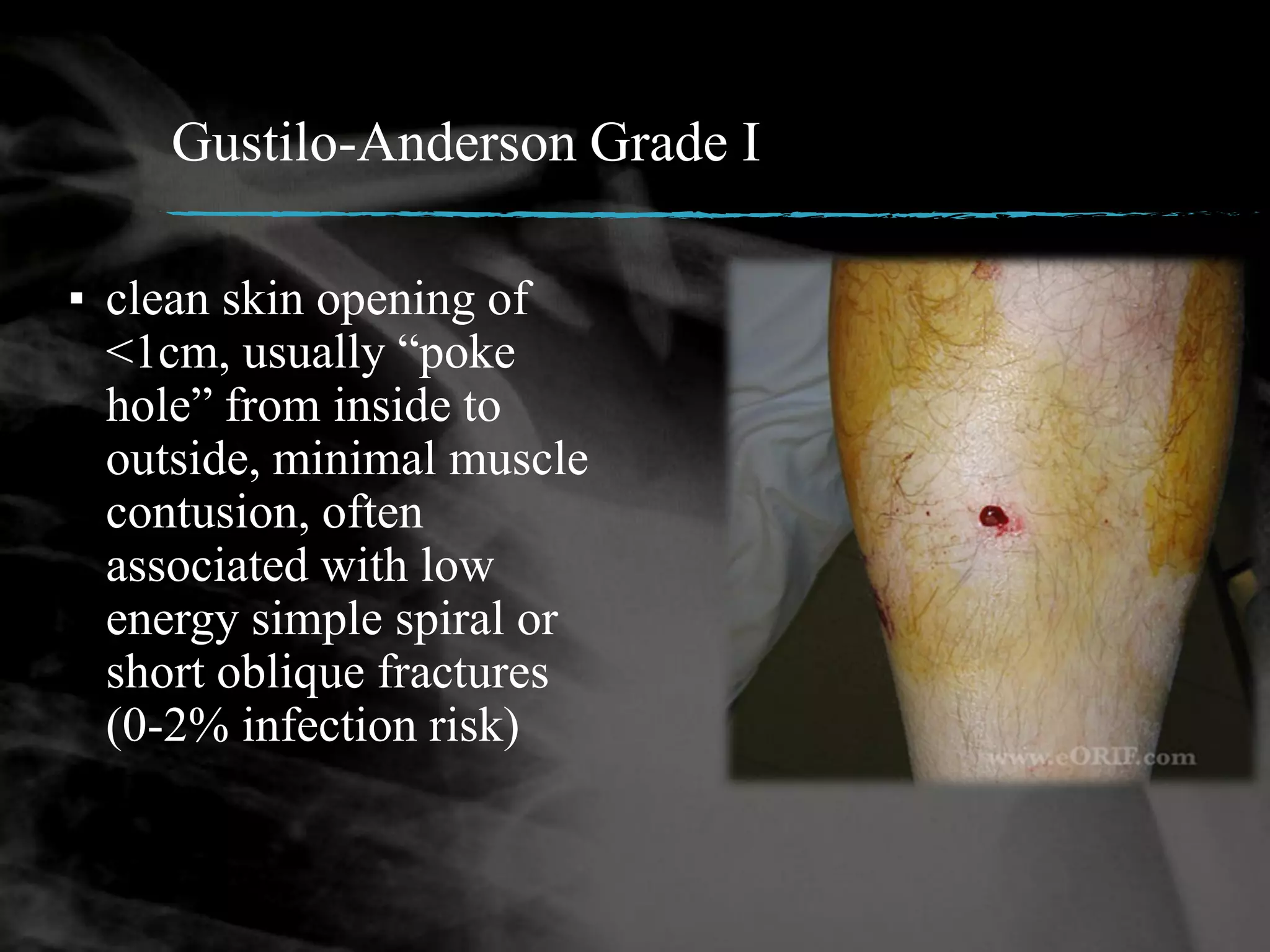 Management of open fracture | PDF