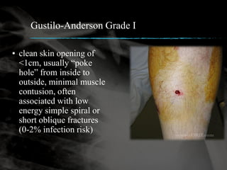 Management of open fracture | PDF