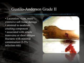 Management of open fracture | PDF