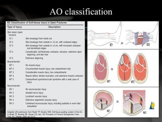 Management of open fracture | PDF