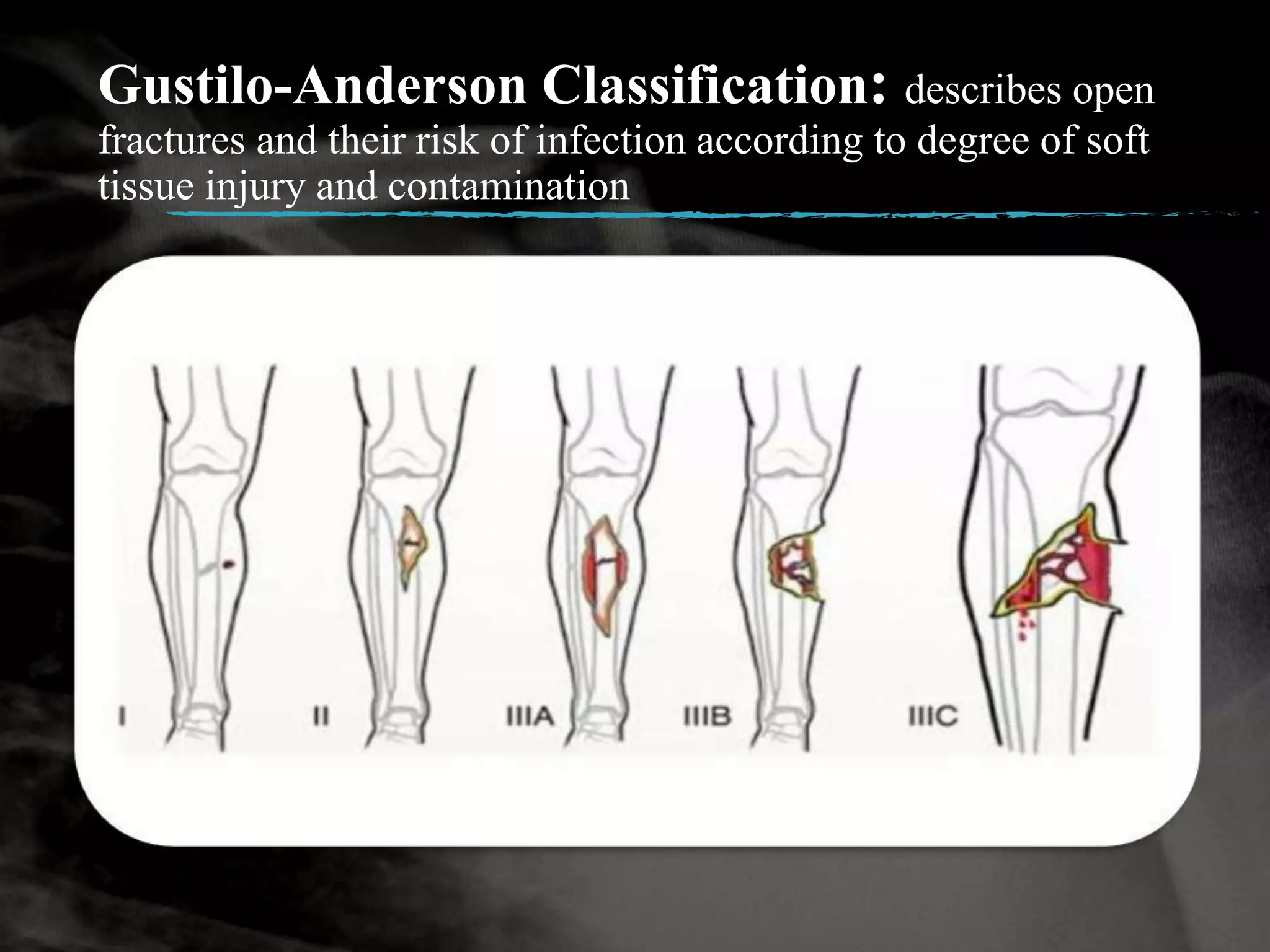 Management of open fracture true ppt | PPTX