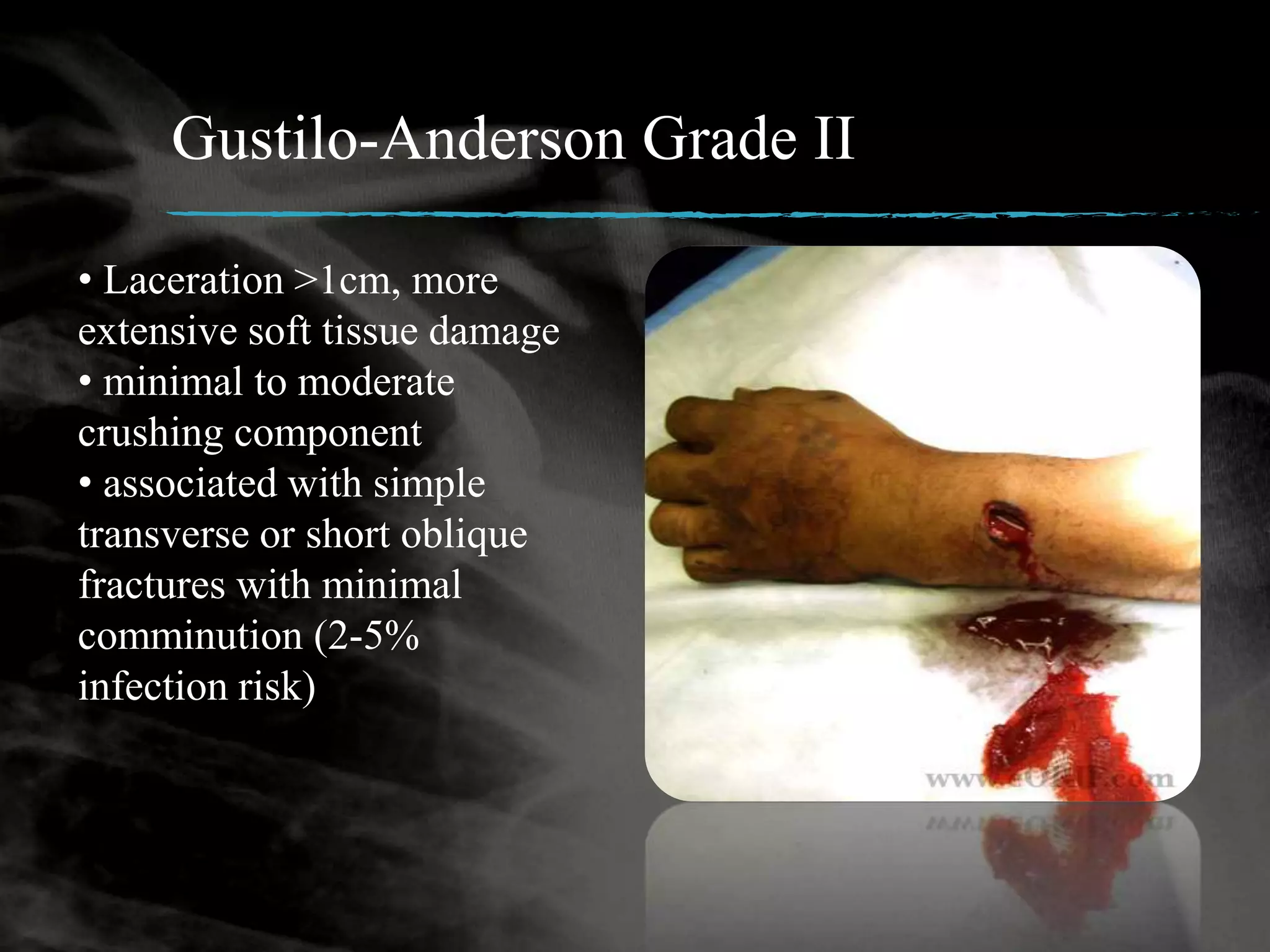Management of open fracture true ppt | PPTX