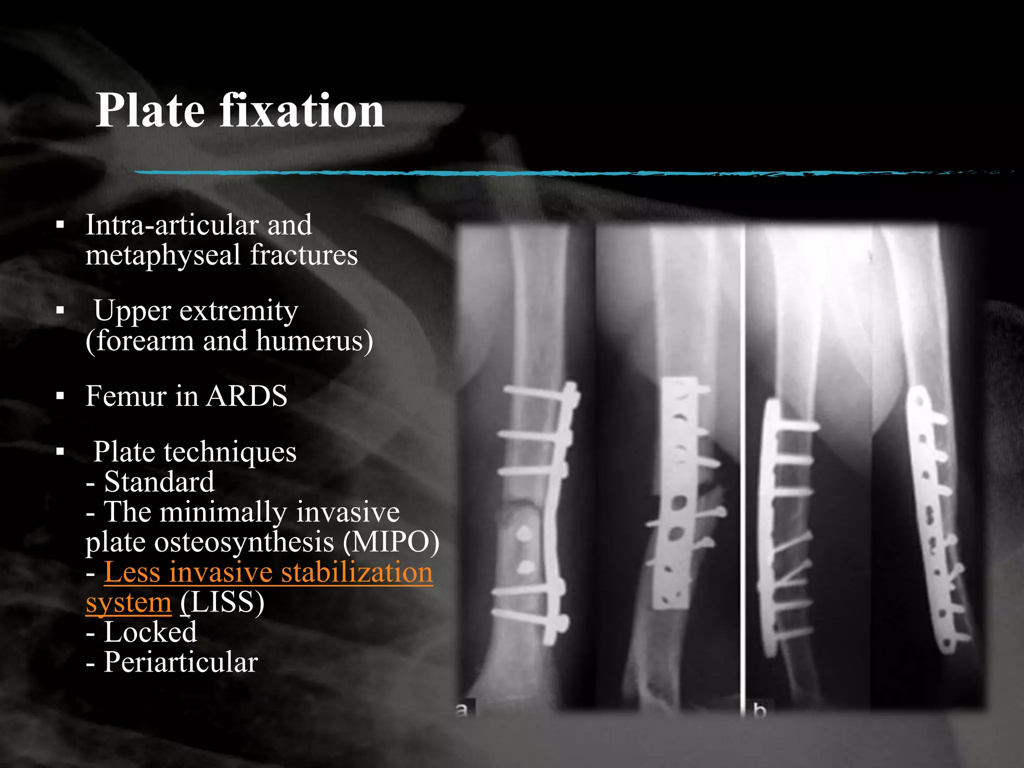 Management of open fracture true ppt | PPTX