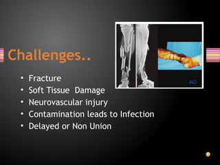 Management of Open Fracture powerpoint ppt | PPTX