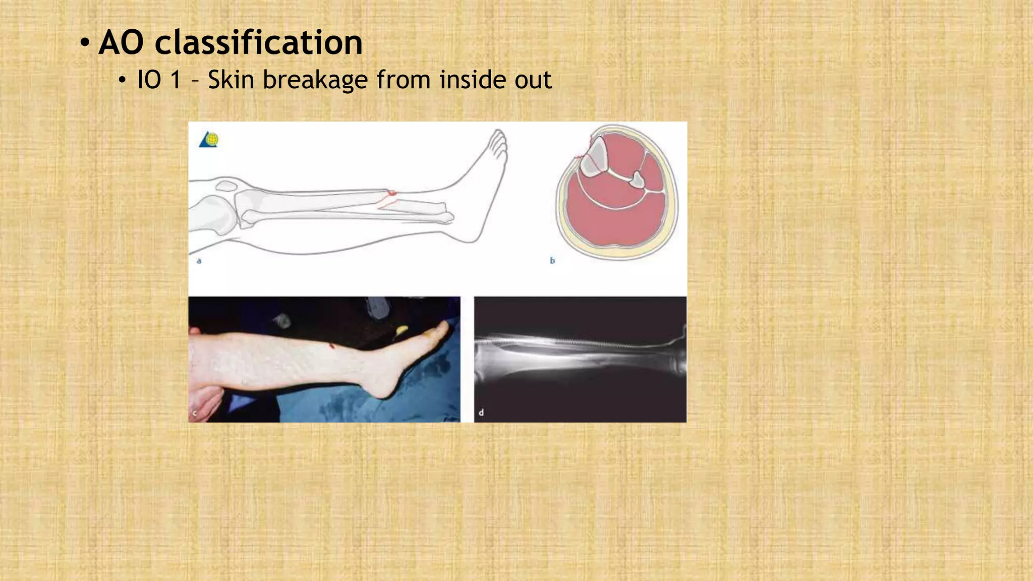 Management of open fractures | PPTX