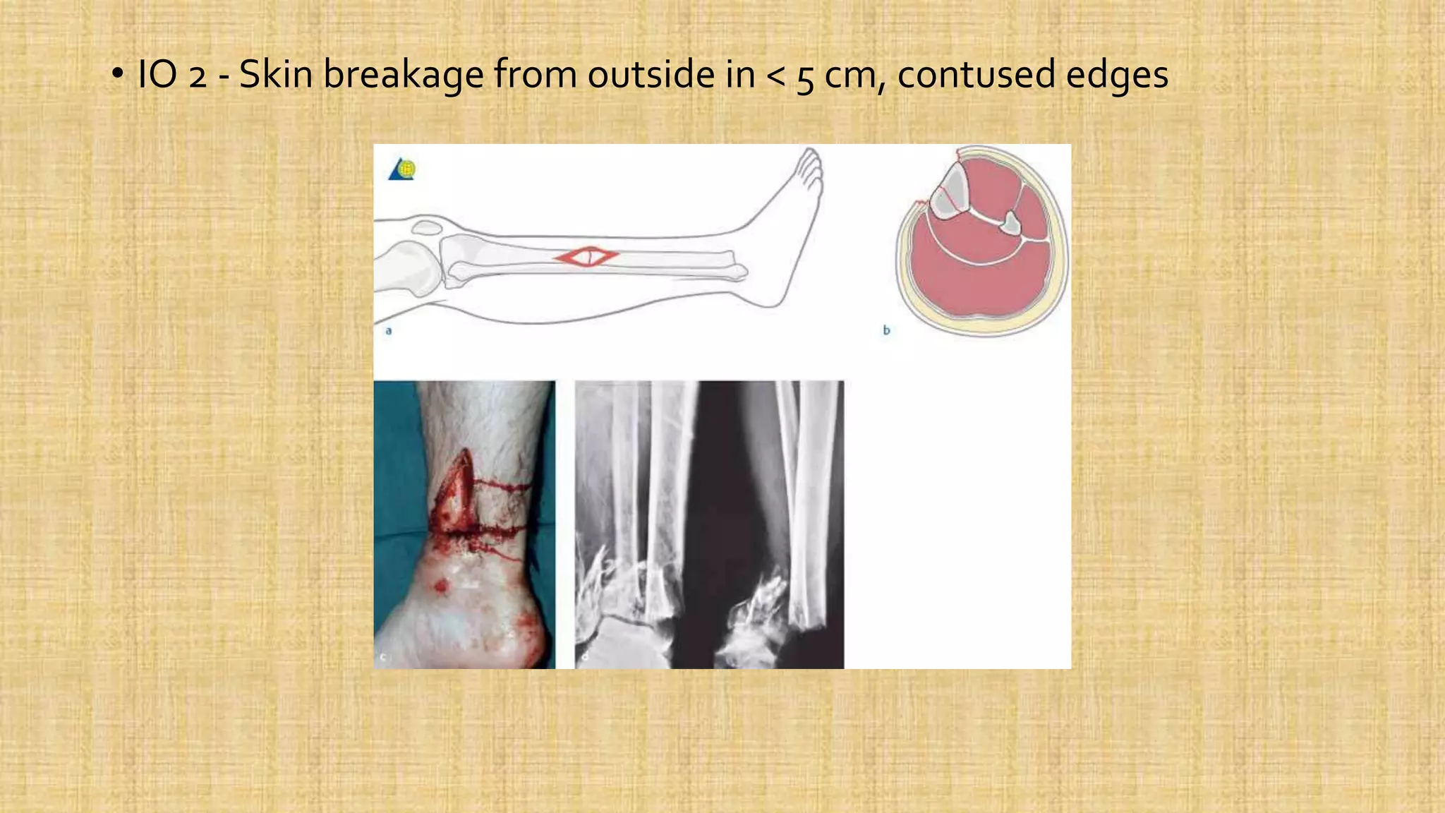 Management of open fractures | PPTX