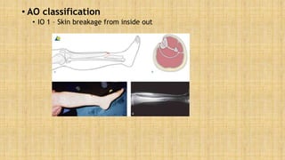 Management of open fractures | PPTX