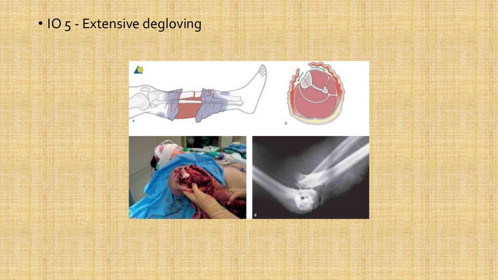 Management of open fractures