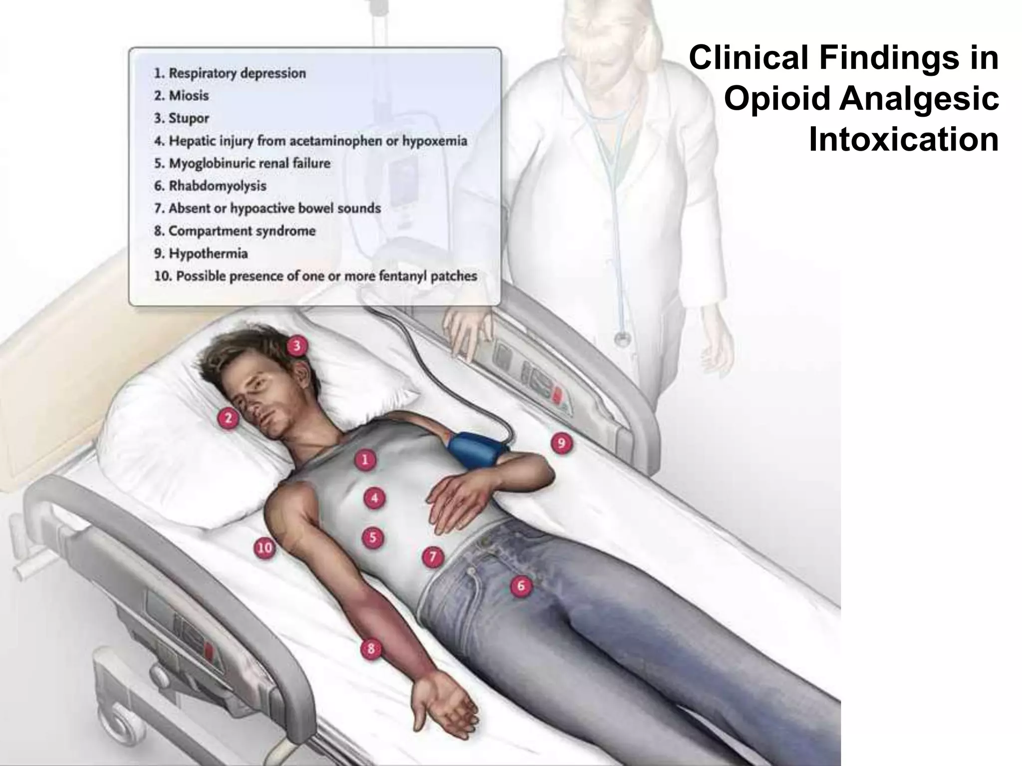 Management of Opioid Analgesic Overdose | PPTX