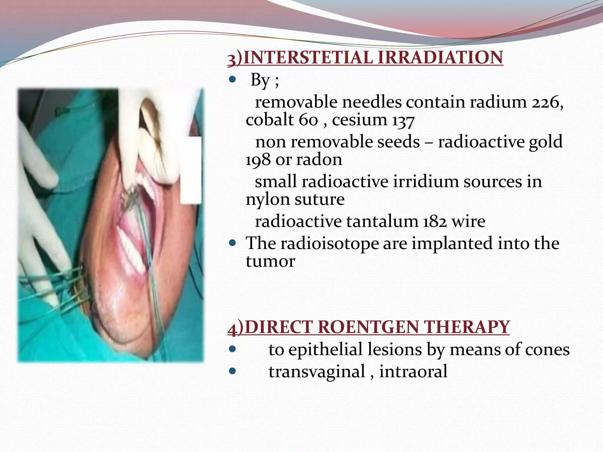 Management of Oral Cancer | PPTX