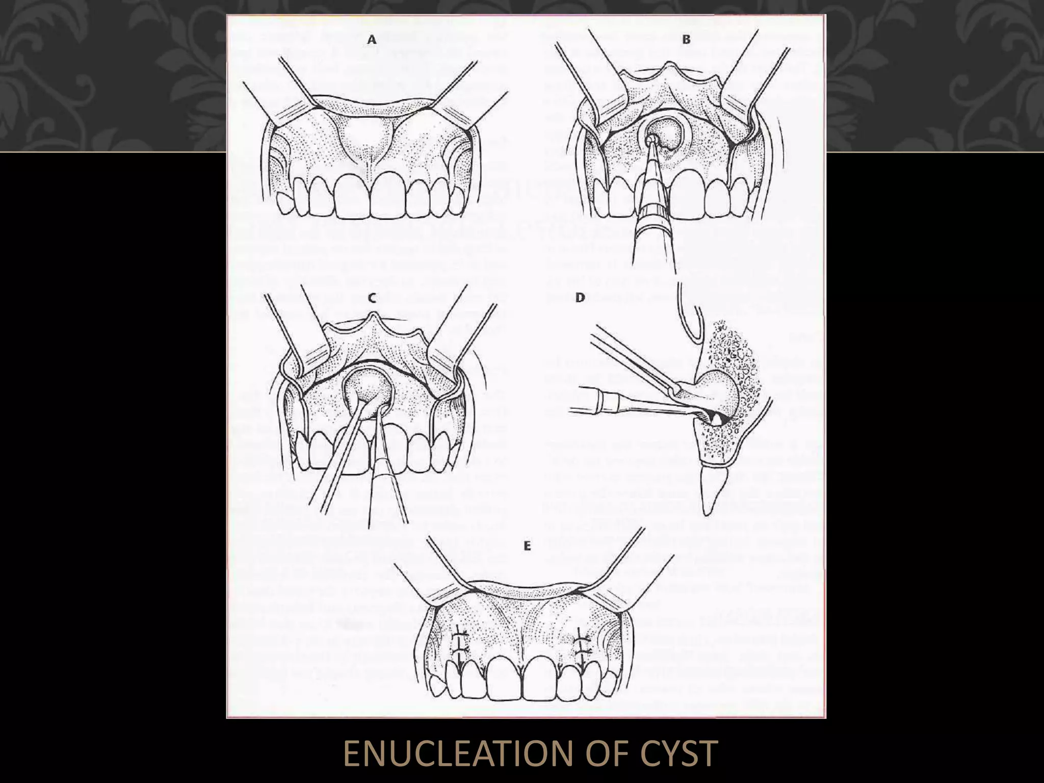 Management of oral cyst | PPTX