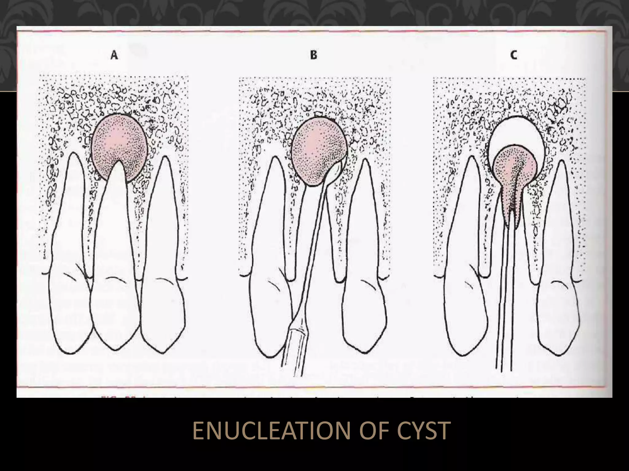 Management of oral cyst | PPTX