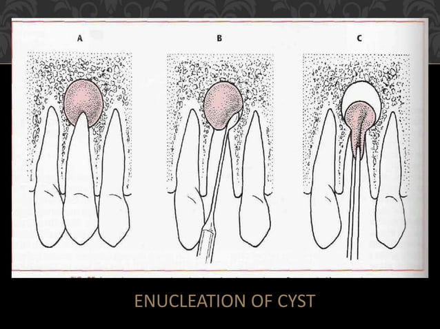 Management of oral cyst | PPTX | Dental Health | Diseases and Conditions