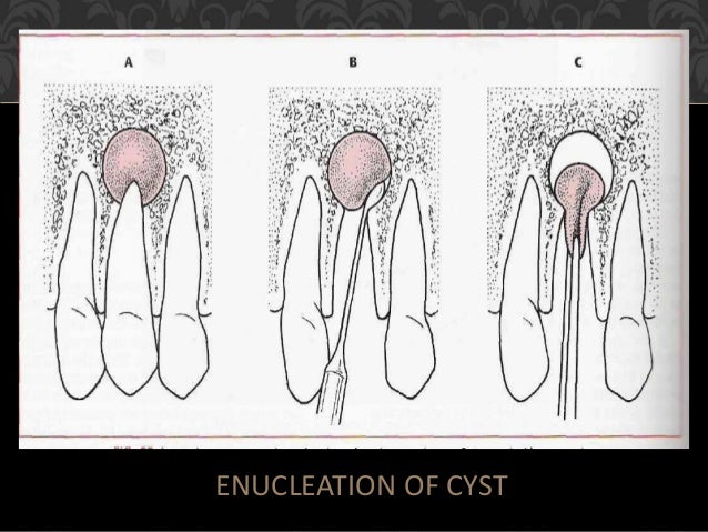 Management of oral cyst