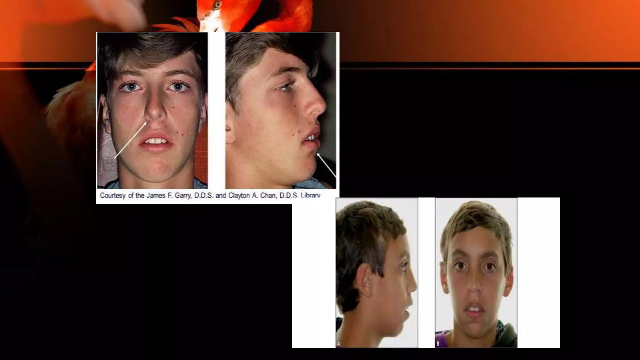 ORAL HABITS - DEFINITION, CLASSIFICATIONS, CLINICAL FEATURES AND ...