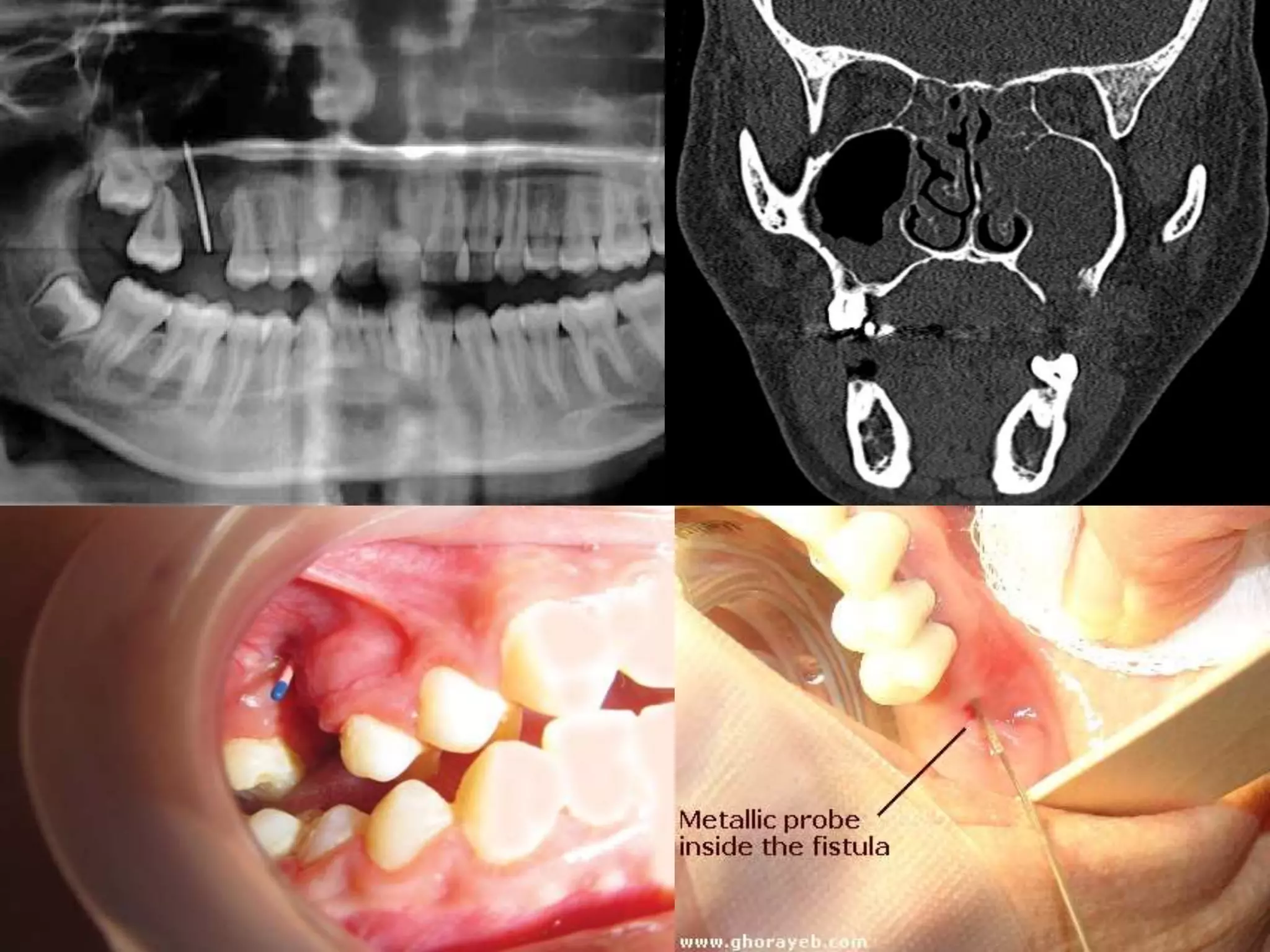 Management of oro antral fistula | PPTX