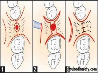 Management of oro antral fistula | PPT