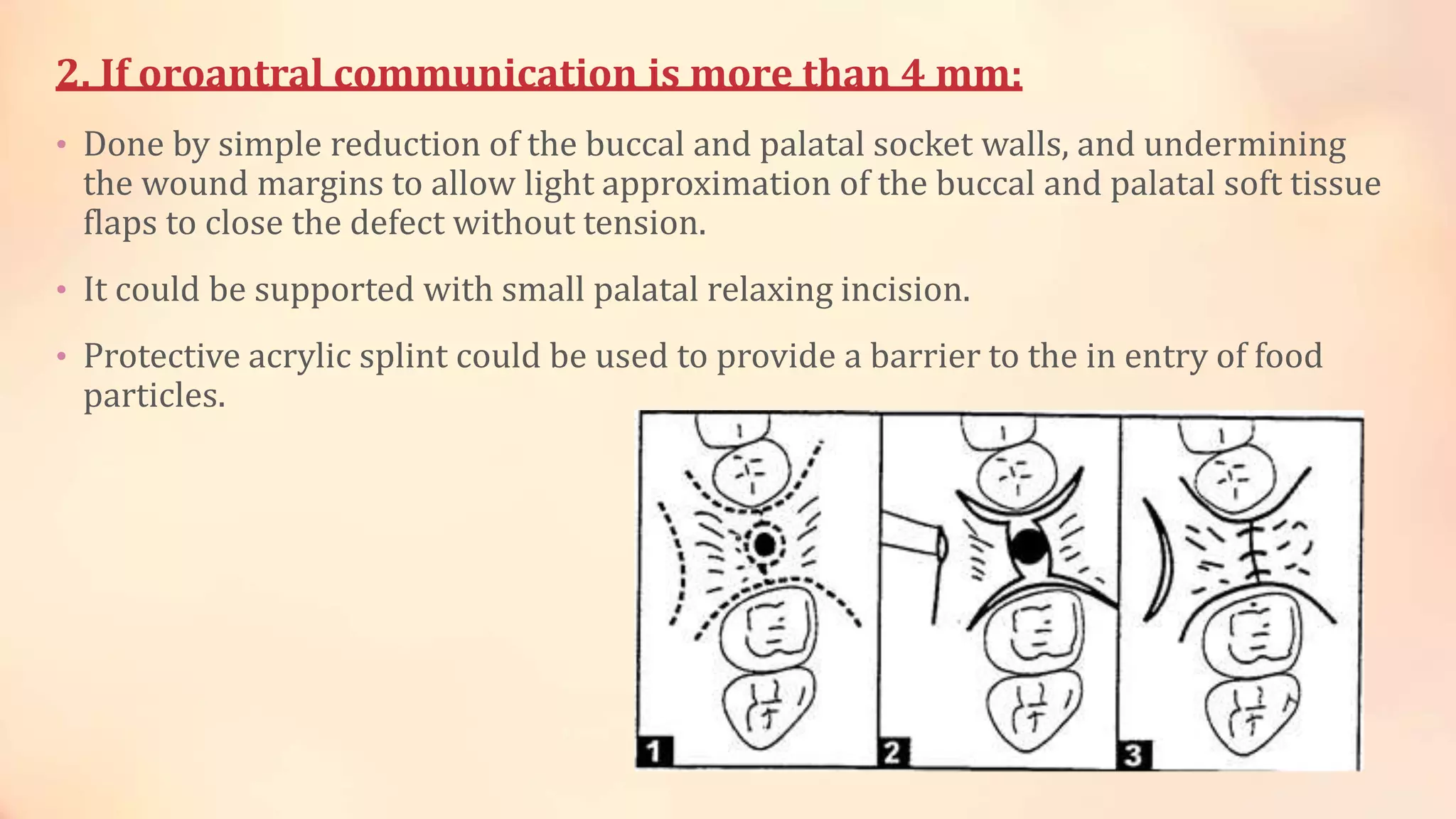 Management of oroantral fistula | PPTX
