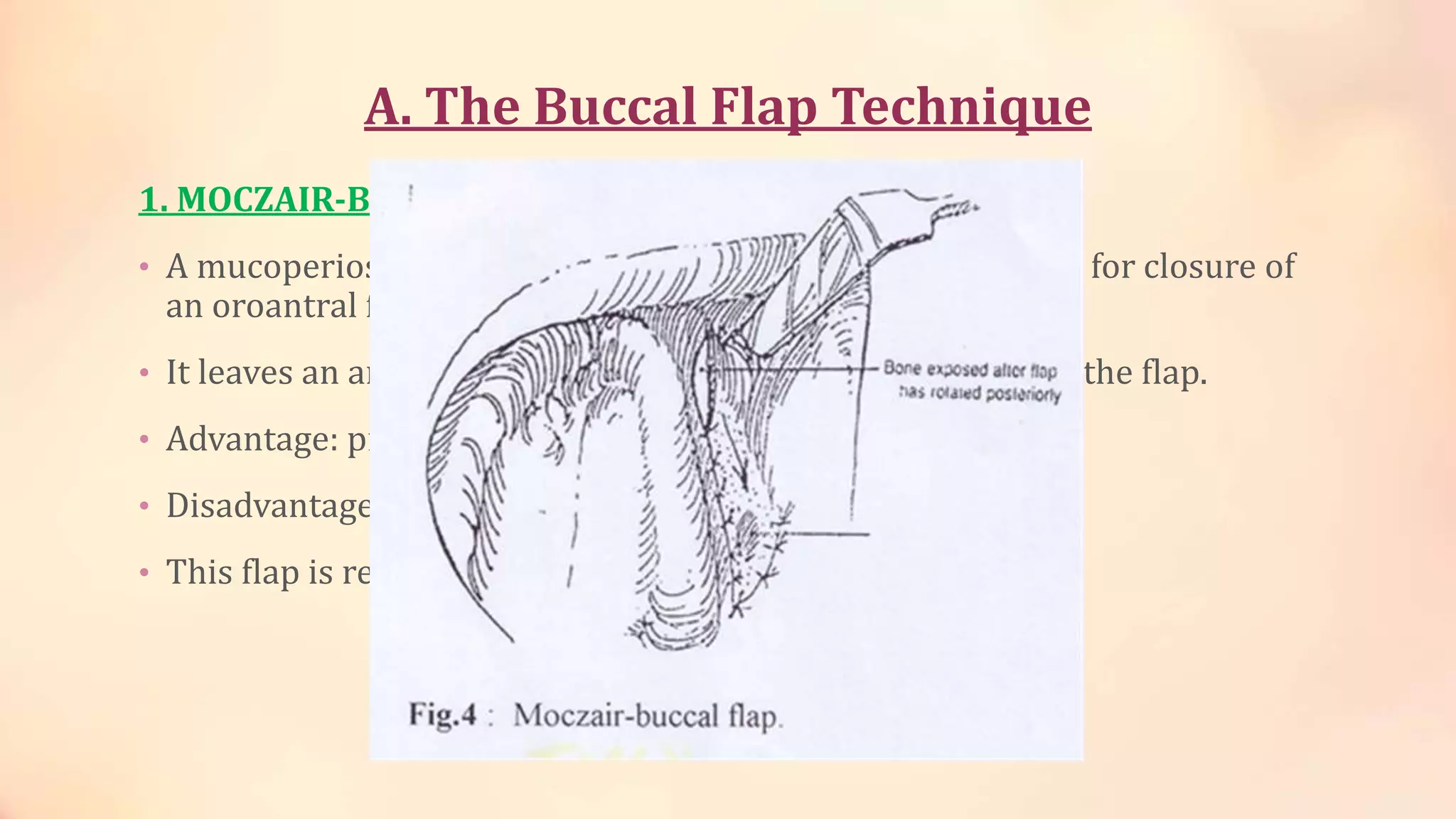 Management of oroantral fistula | PPTX