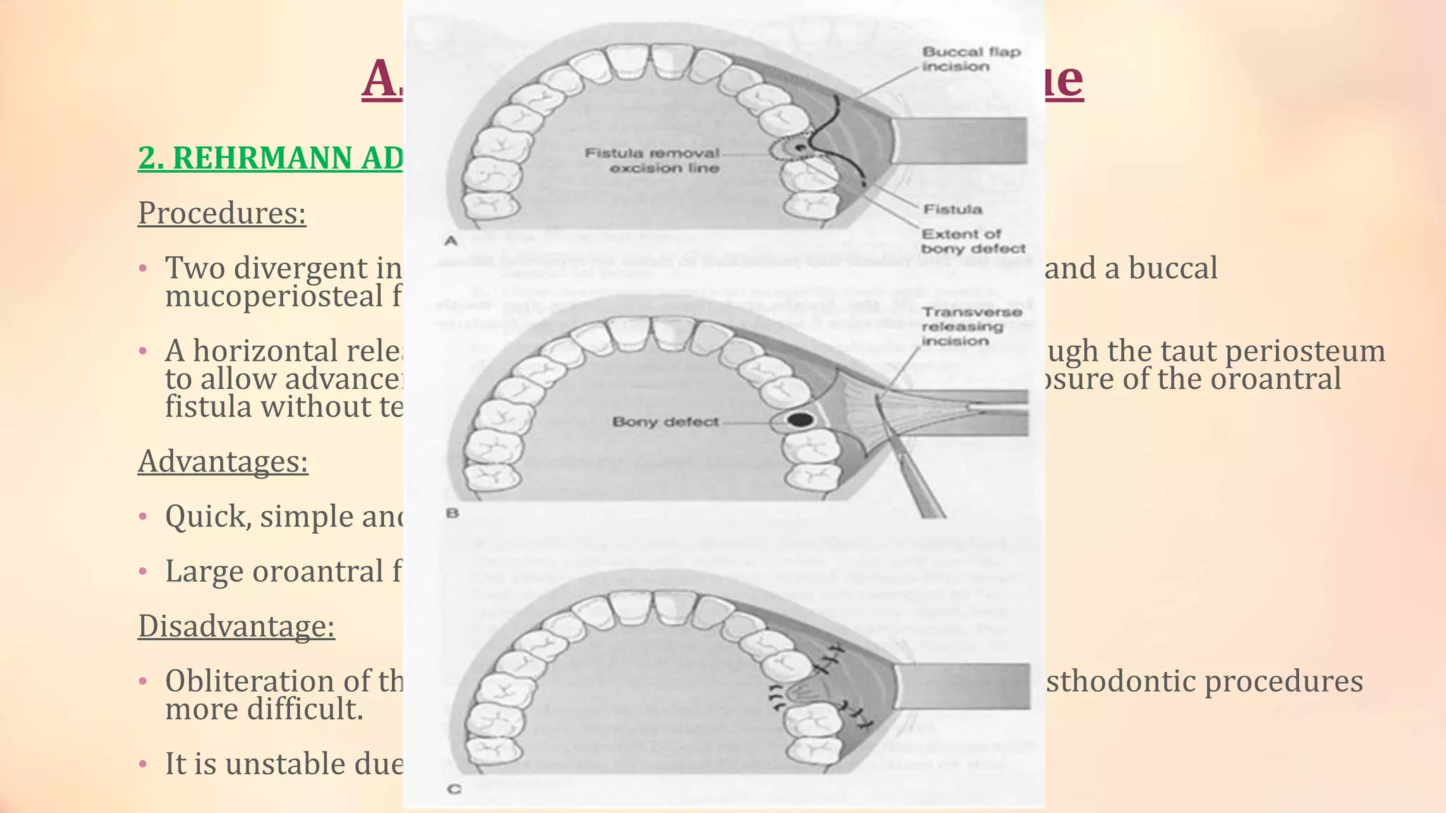 Management of oroantral fistula | PPTX