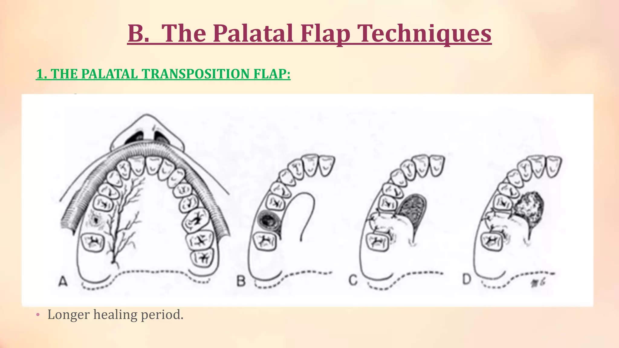Management of oroantral fistula | PPTX