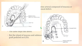 Management of oroantral fistula | PPTX