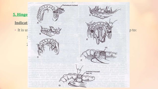 Management of oroantral fistula | PPTX