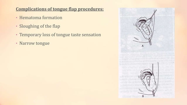 Management of oroantral fistula | PPTX