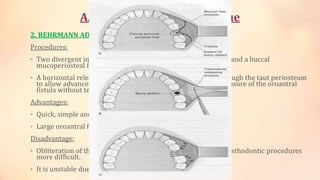 Management of oroantral fistula | PPT