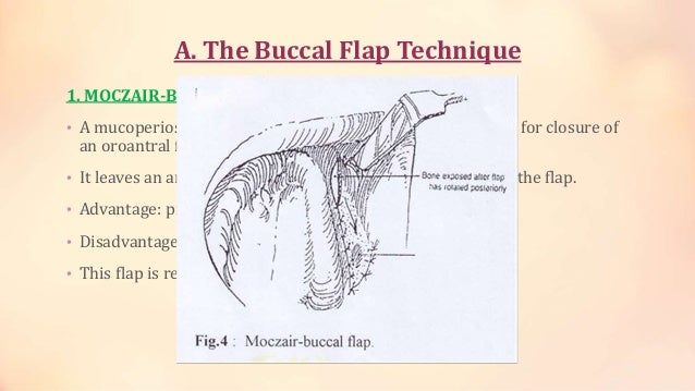 Management of oroantral fistula