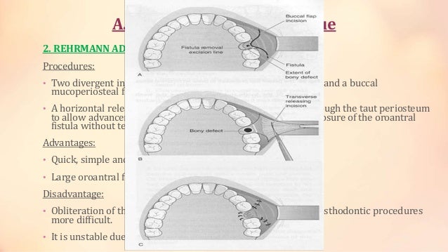 Management of oroantral fistula