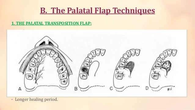 Management of oroantral fistula