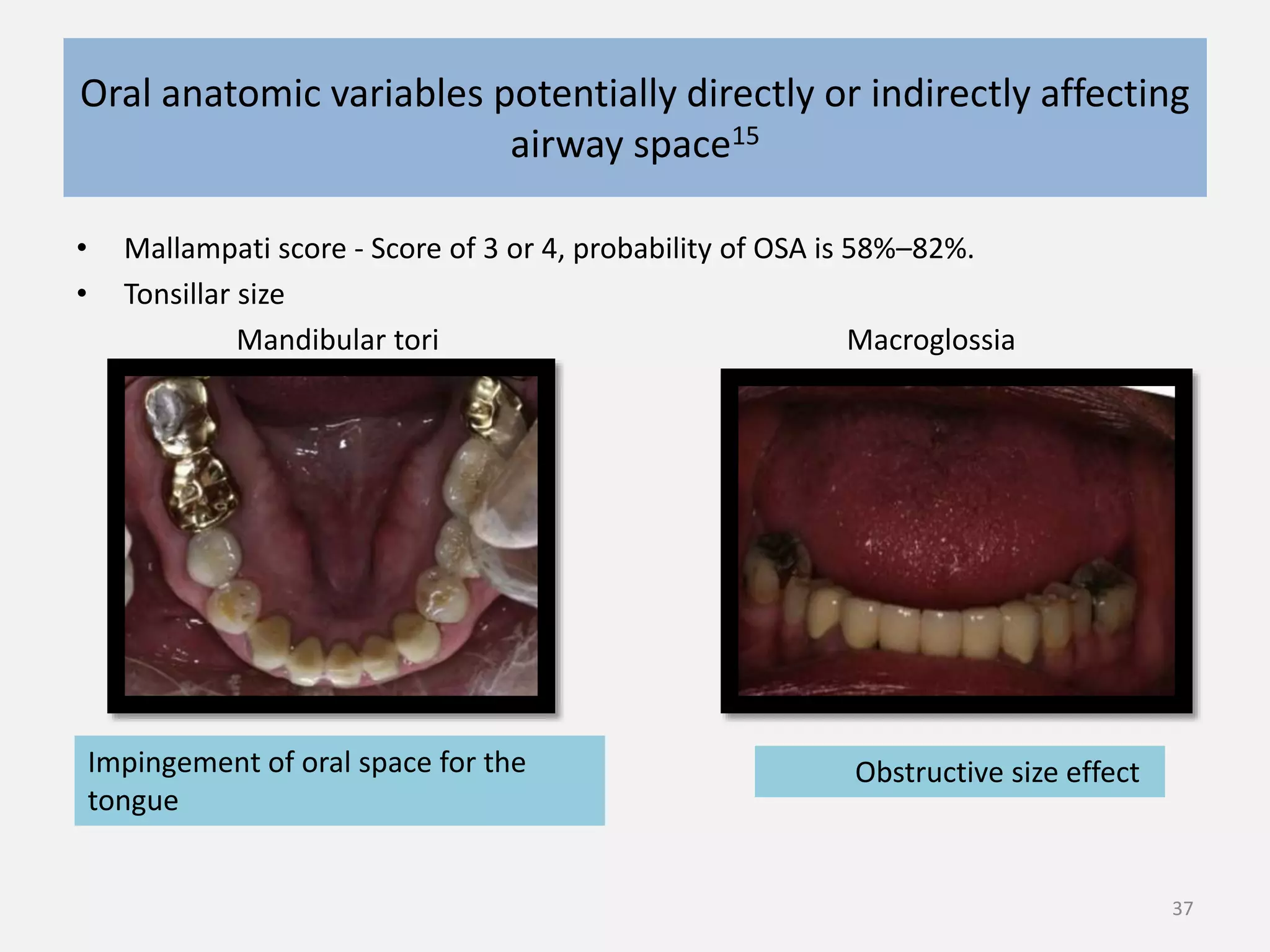 Management of obstructive sleep apnea | PPTX