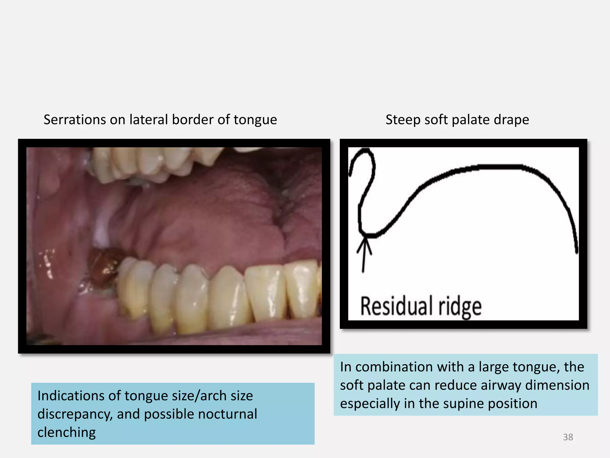 Management of obstructive sleep apnea | PPTX