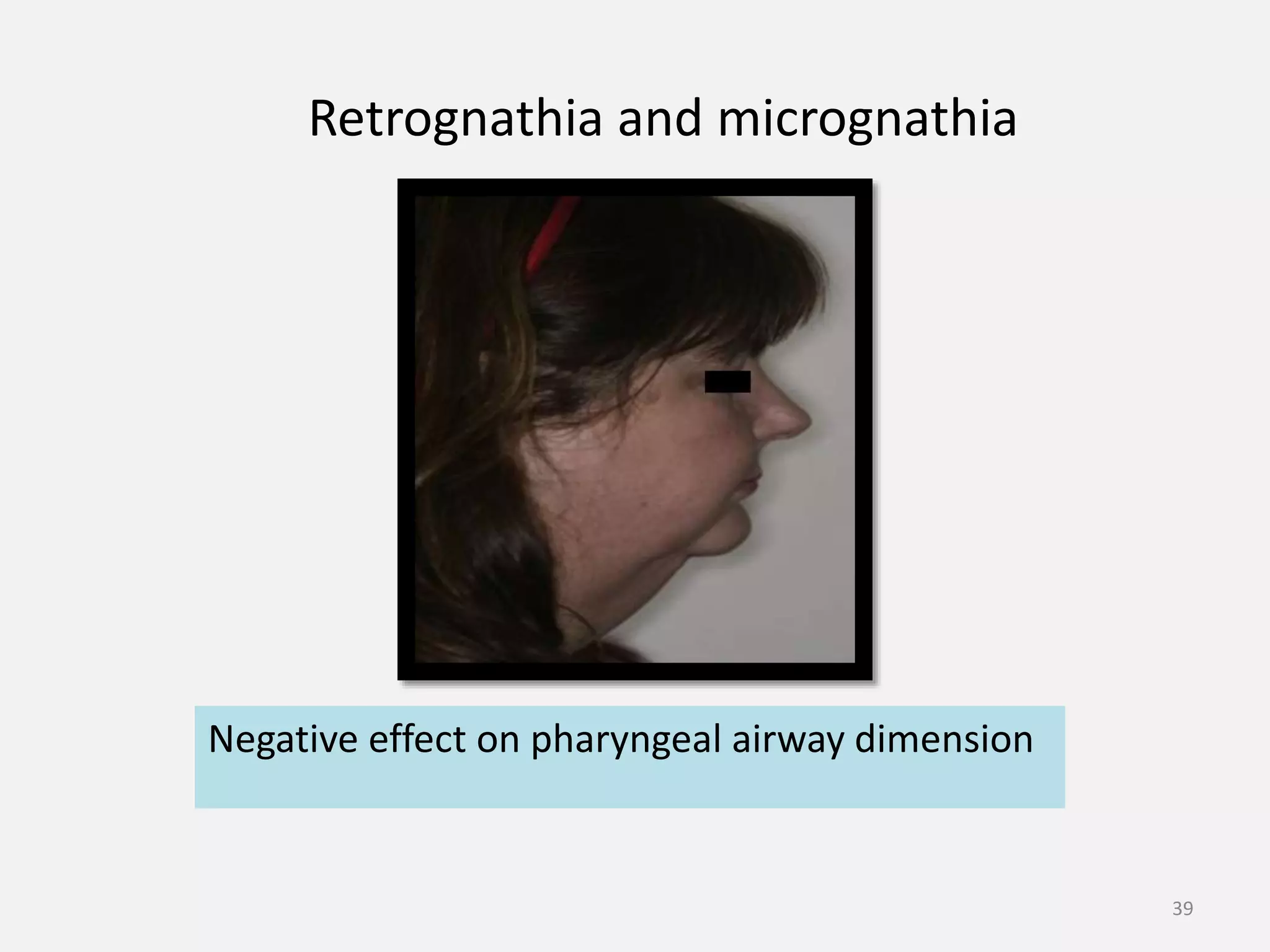 Management of obstructive sleep apnea | PPTX