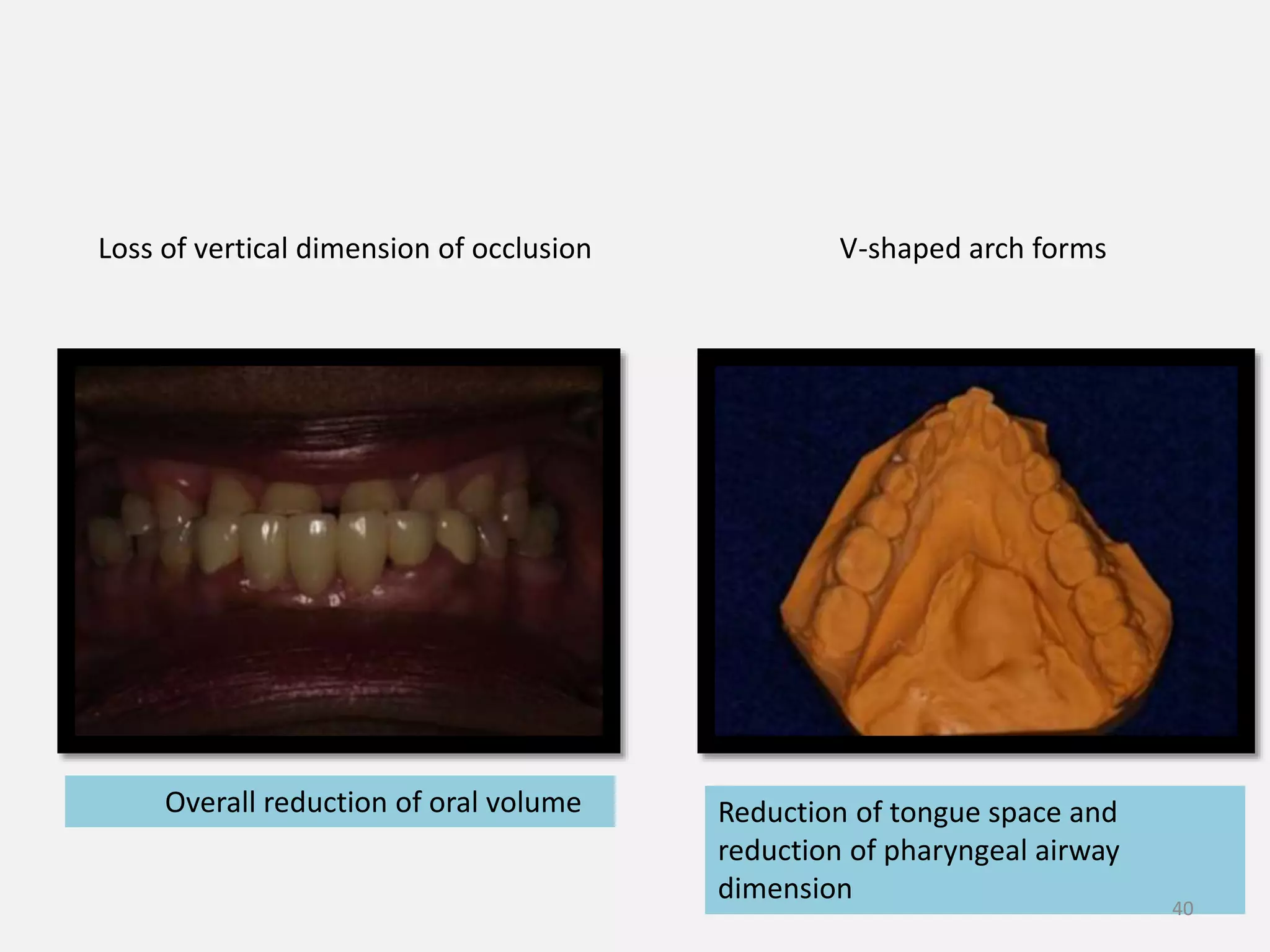 Management of obstructive sleep apnea | PPTX