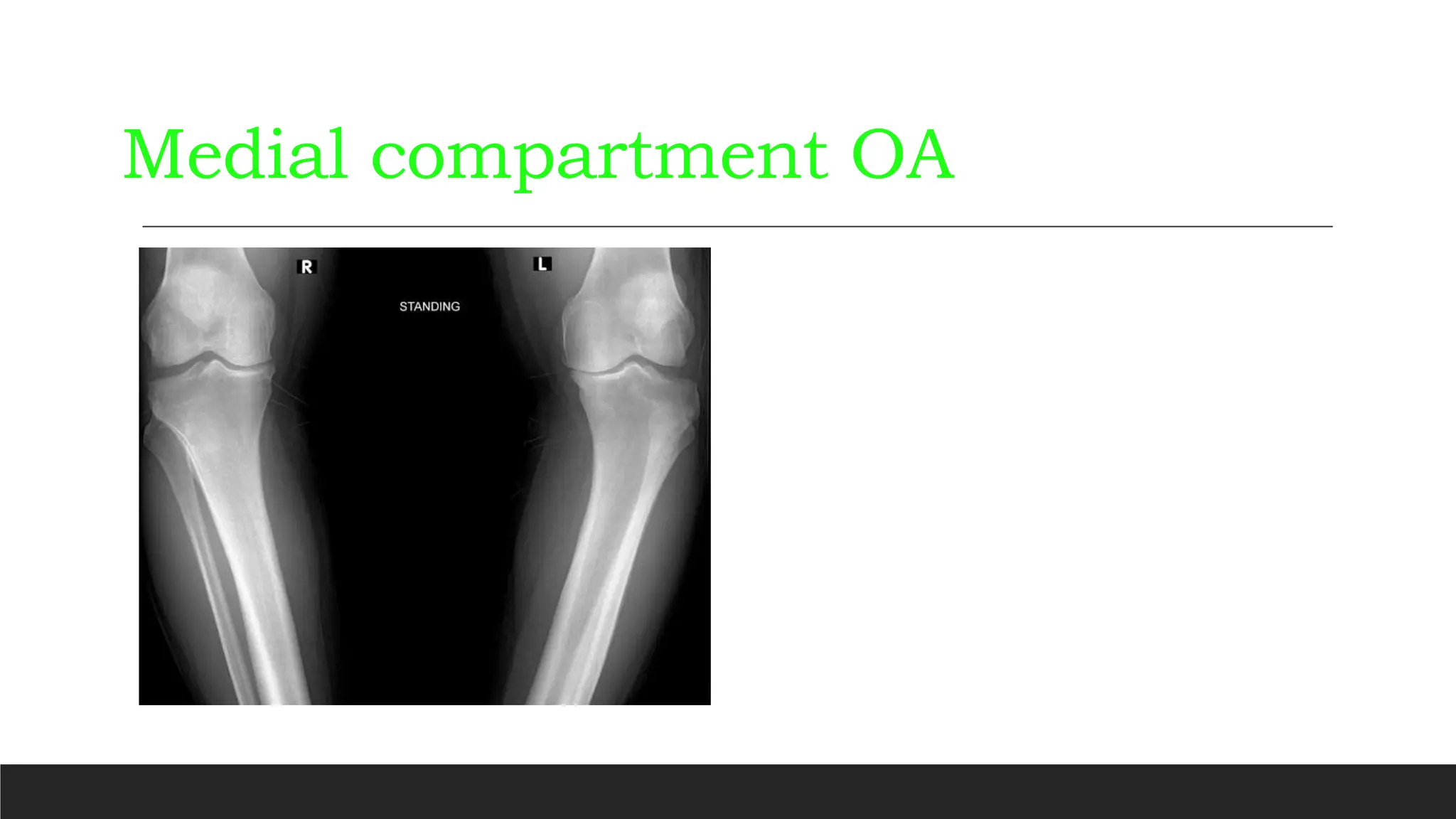 Management of Osteoarthritis of knee by High tibial.pptx