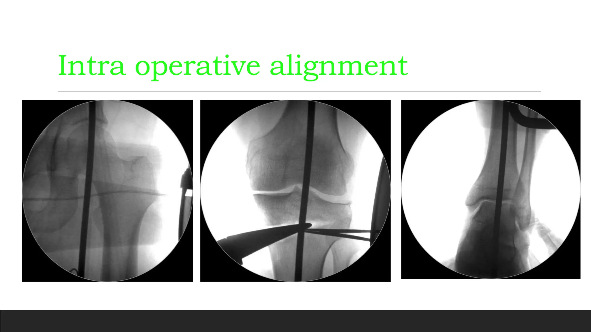 Management of Osteoarthritis of knee by High tibial.pptx