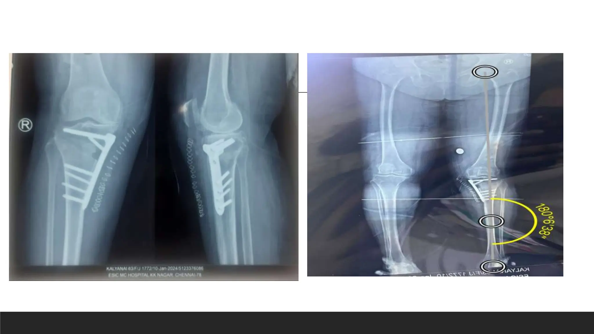 Management of Osteoarthritis of knee by High tibial.pptx