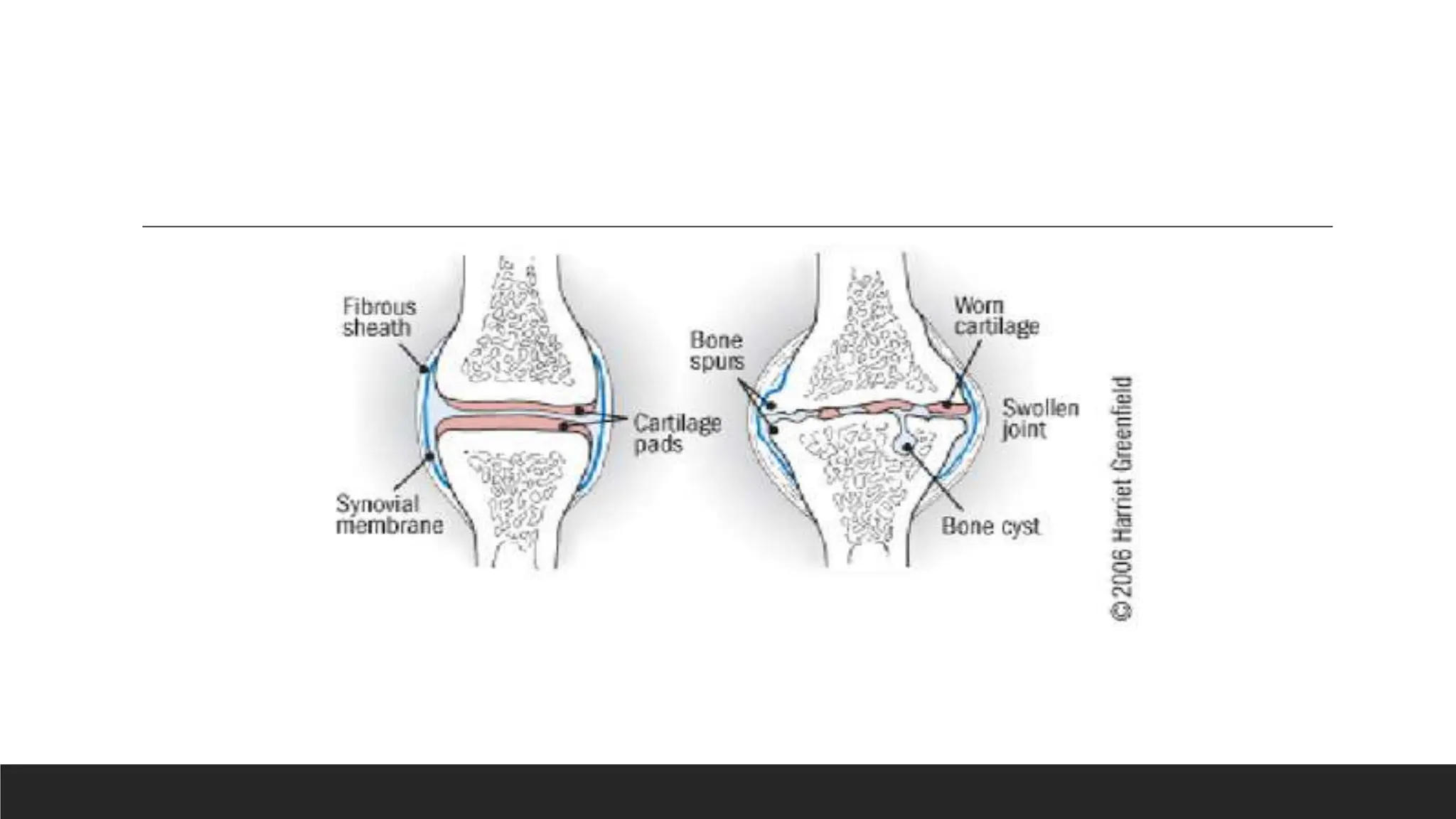 Management of Osteoarthritis of knee by High tibial.pptx