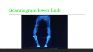 Management of Osteoarthritis of knee by High tibial.pptx