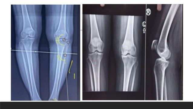 Management of Osteoarthritis of knee by High tibial.pptx