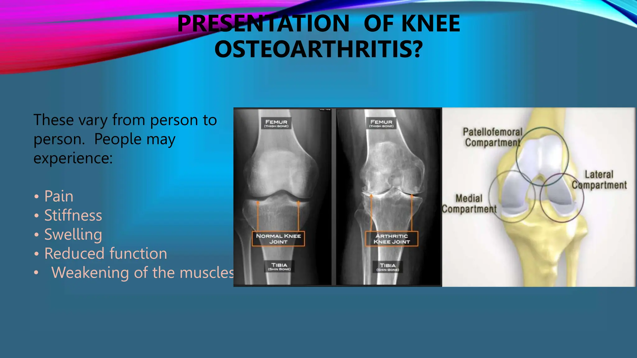 Management of Osteoarthritis of the Knee last.pptx