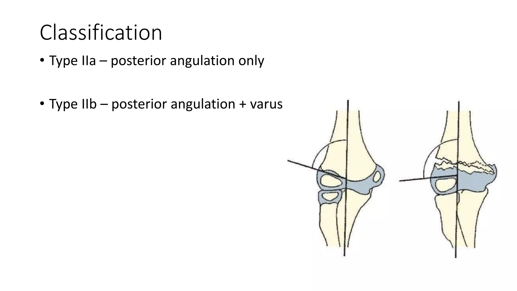 Management of paediatric supracondlar humeral fractures | PPTX