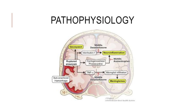 Management of Pain After Aneurysmal Subarachnoid Hemorrhage | PPT